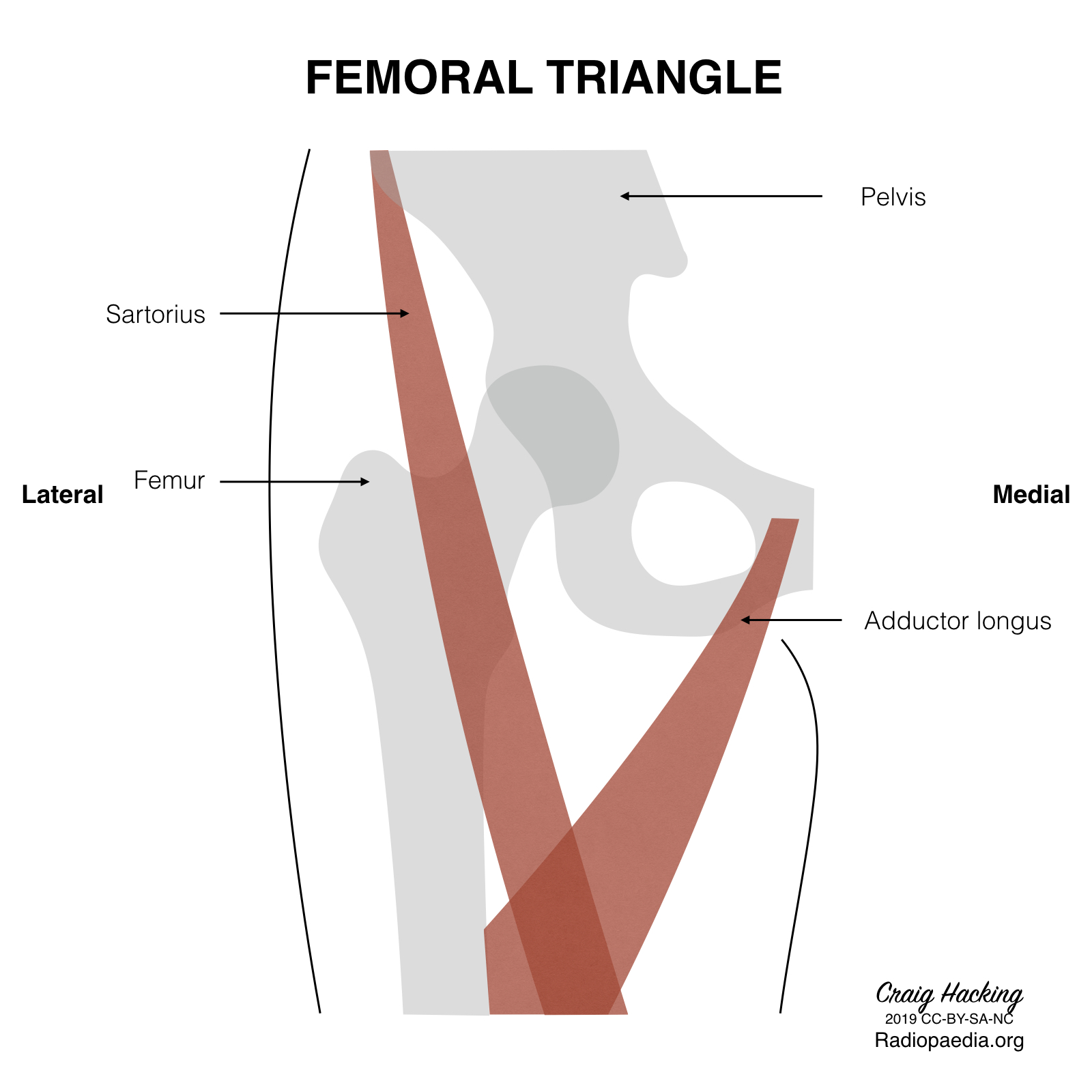 Radiopaedia - Drawing Muscle borders of the femoral triangle - English labels | AnatomyTOOL